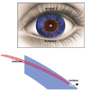 Laser Refractive Eye Surgery: A Concise Overview - Journal of the ...