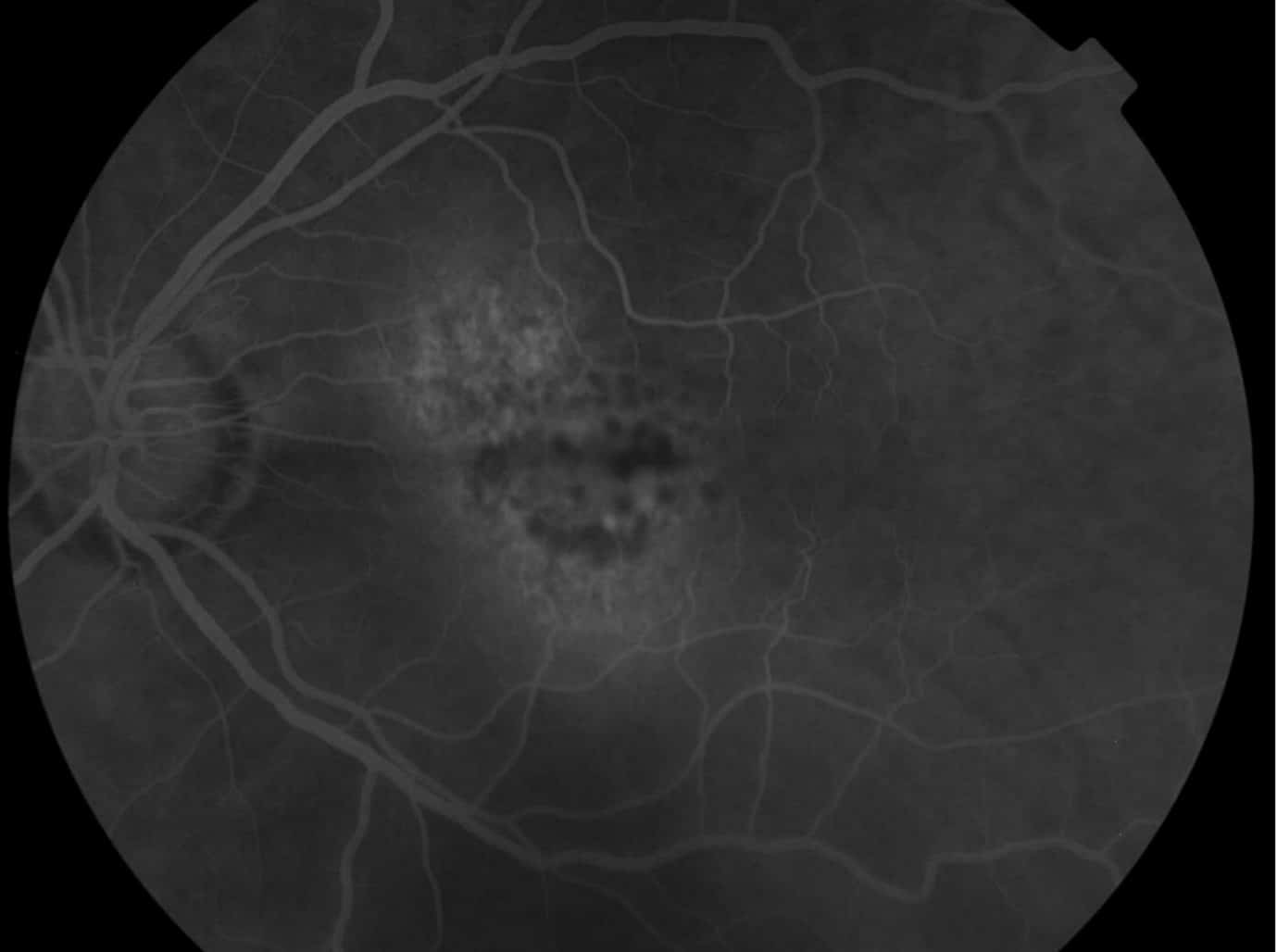 Dome Shaped Maculopathy - Journal of the Foundations of Ophthalmology