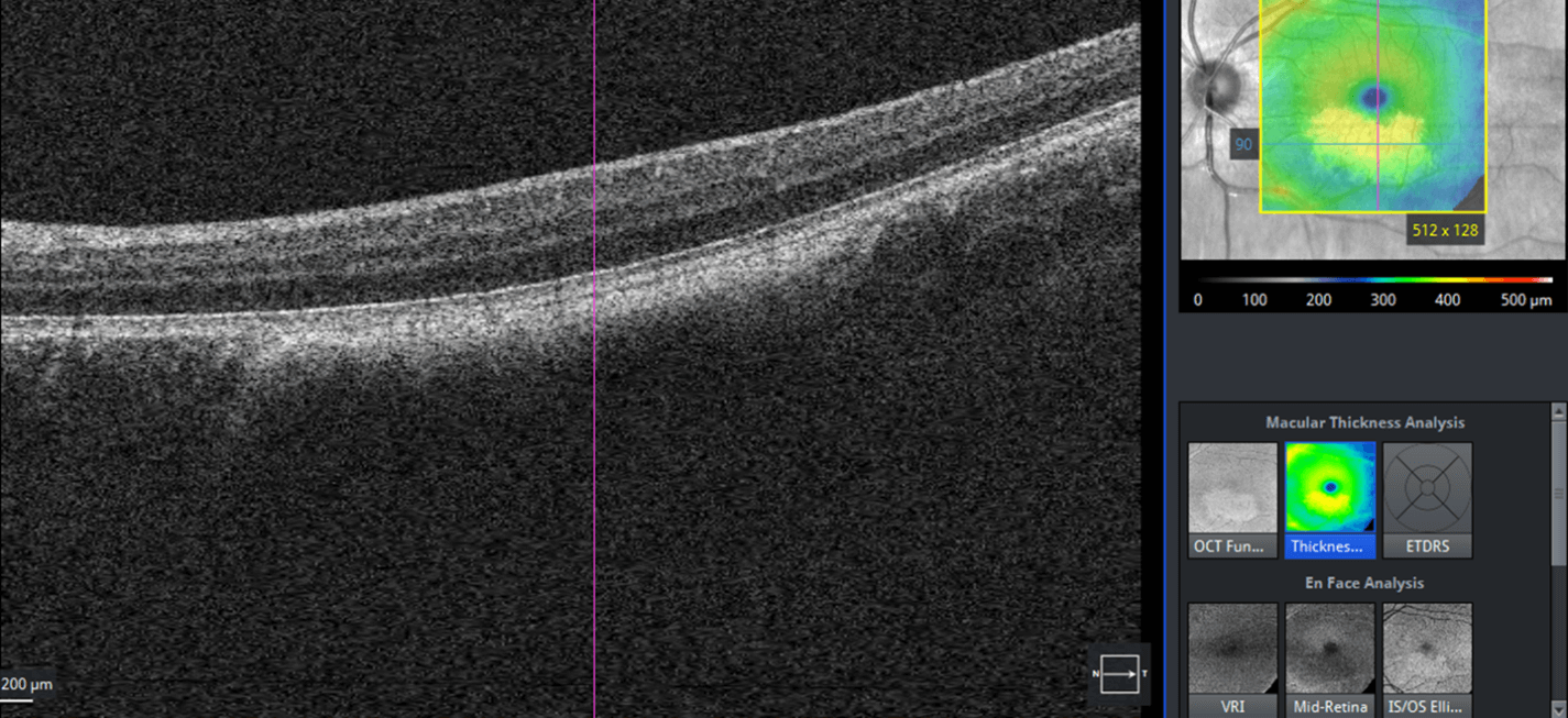 A Case of Choroidal Naevus in a Child - Journal of the Foundations of ...