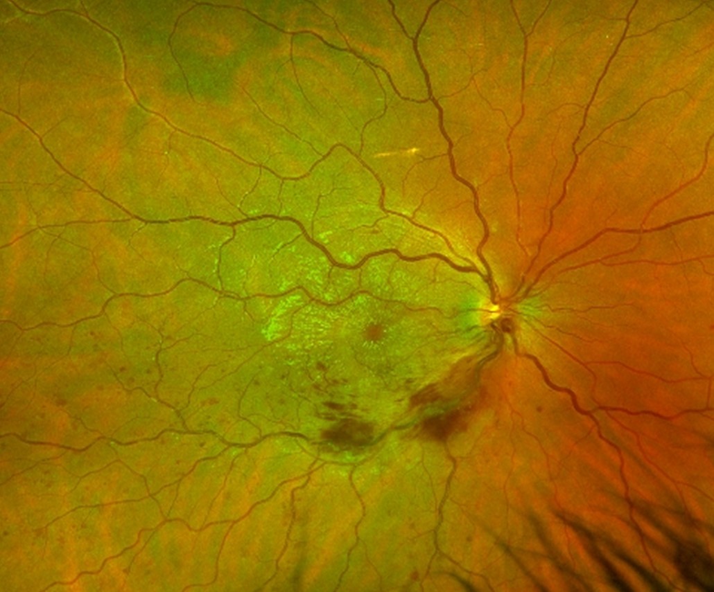 Venous Retinal Branch Occlusion Associated with Isotretinoin Use: A ...