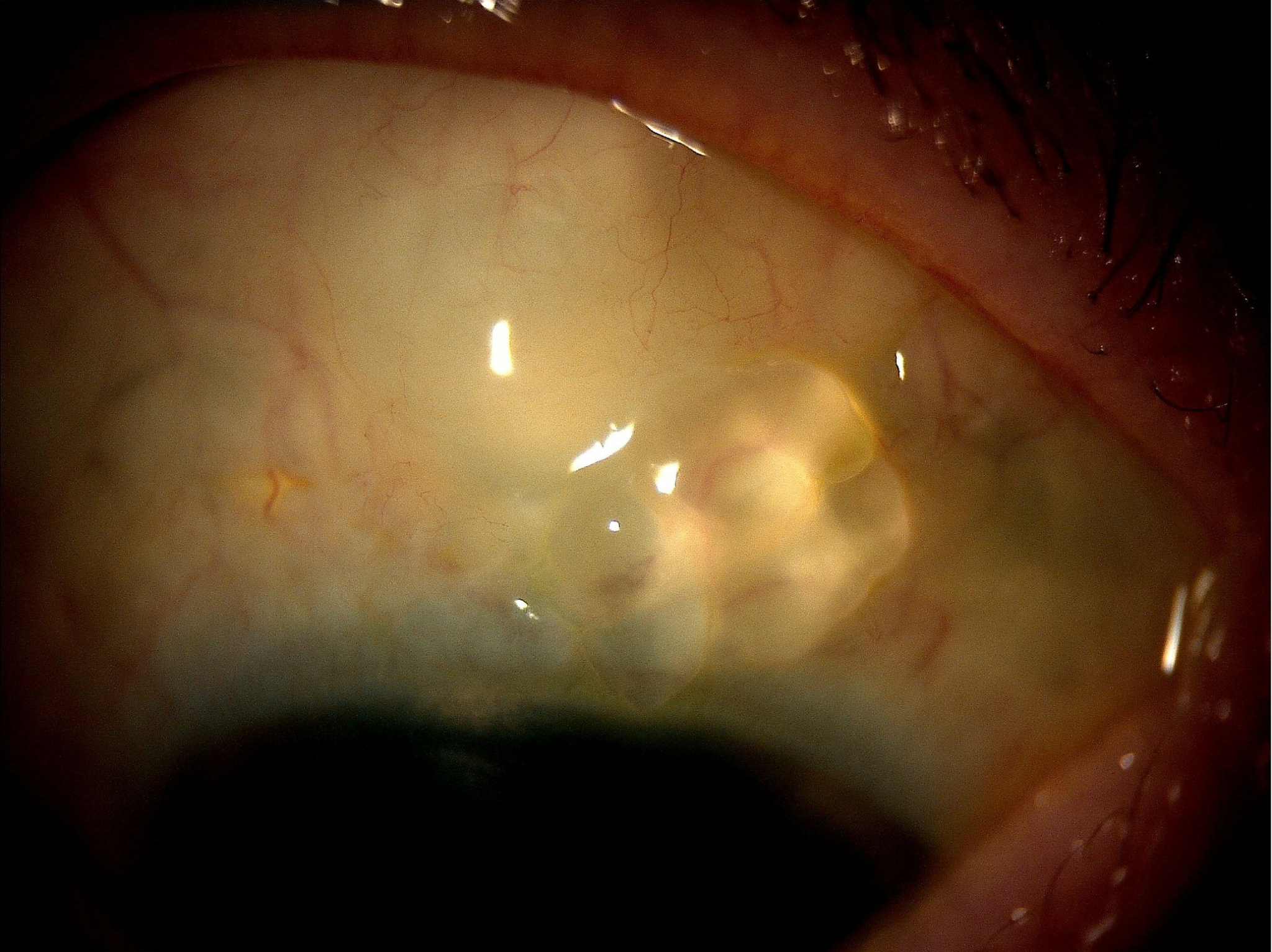 A Case of Bleb Related Endophthalmitis Complicated with Retinal Detachment - Journal of the ...