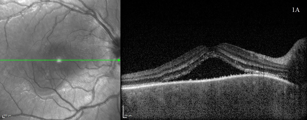Diagnosis and Management of Vogt-Koyanagi-Harada Disease in a ...