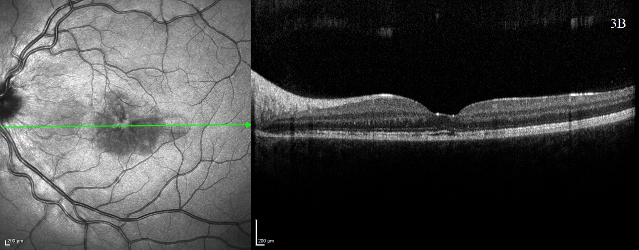 Diagnosis and Management of Vogt-Koyanagi-Harada Disease in a ...