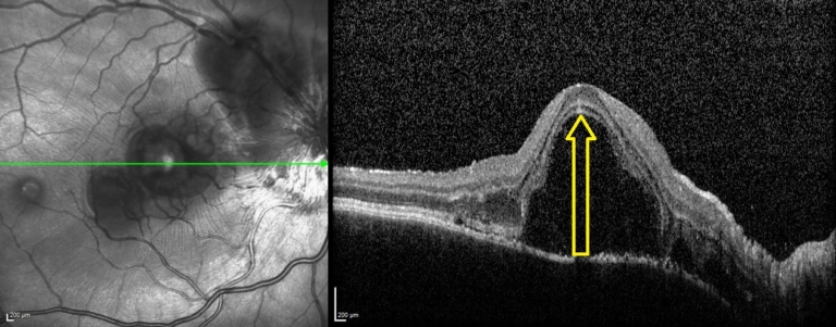 Diagnosis and Management of Vogt-Koyanagi-Harada Disease in a ...