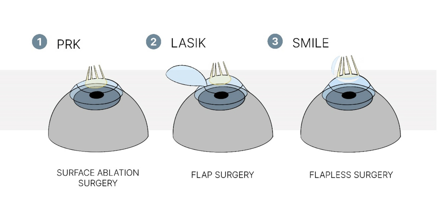 Introduction to Refractive Eye Surgery - Journal of the Foundations of ...