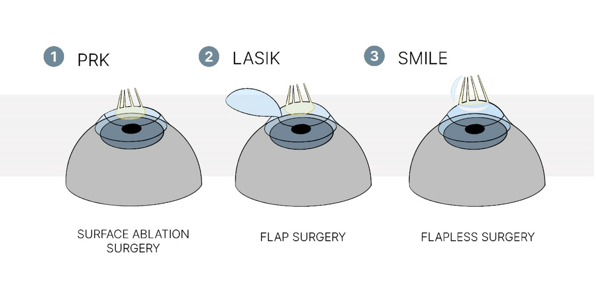 Introduction to Refractive Eye Surgery - Journal of the Foundations of ...