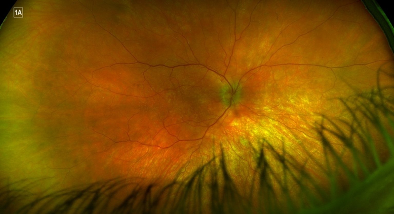 The Great Masquerader: A Clinical Case - Journal of the Foundations of ...