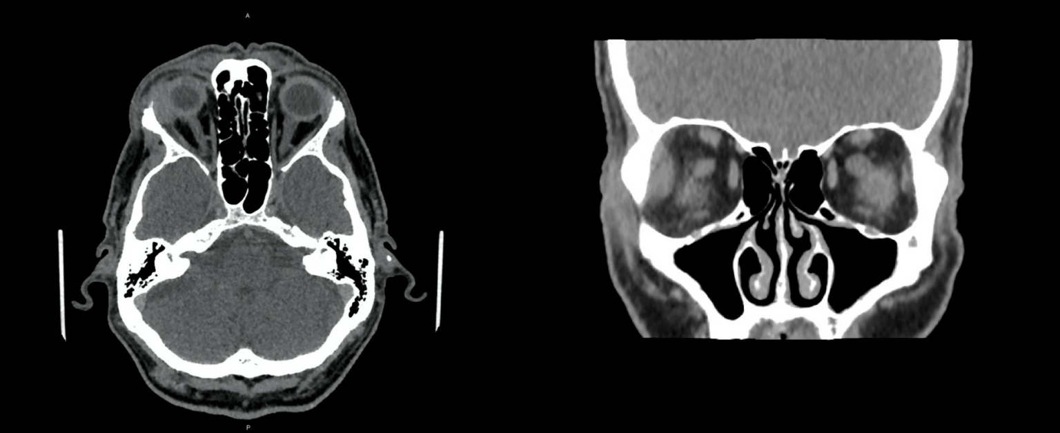 Lyme Disease Associated Orbital Myositis: A Rare Cause of Orbital ...