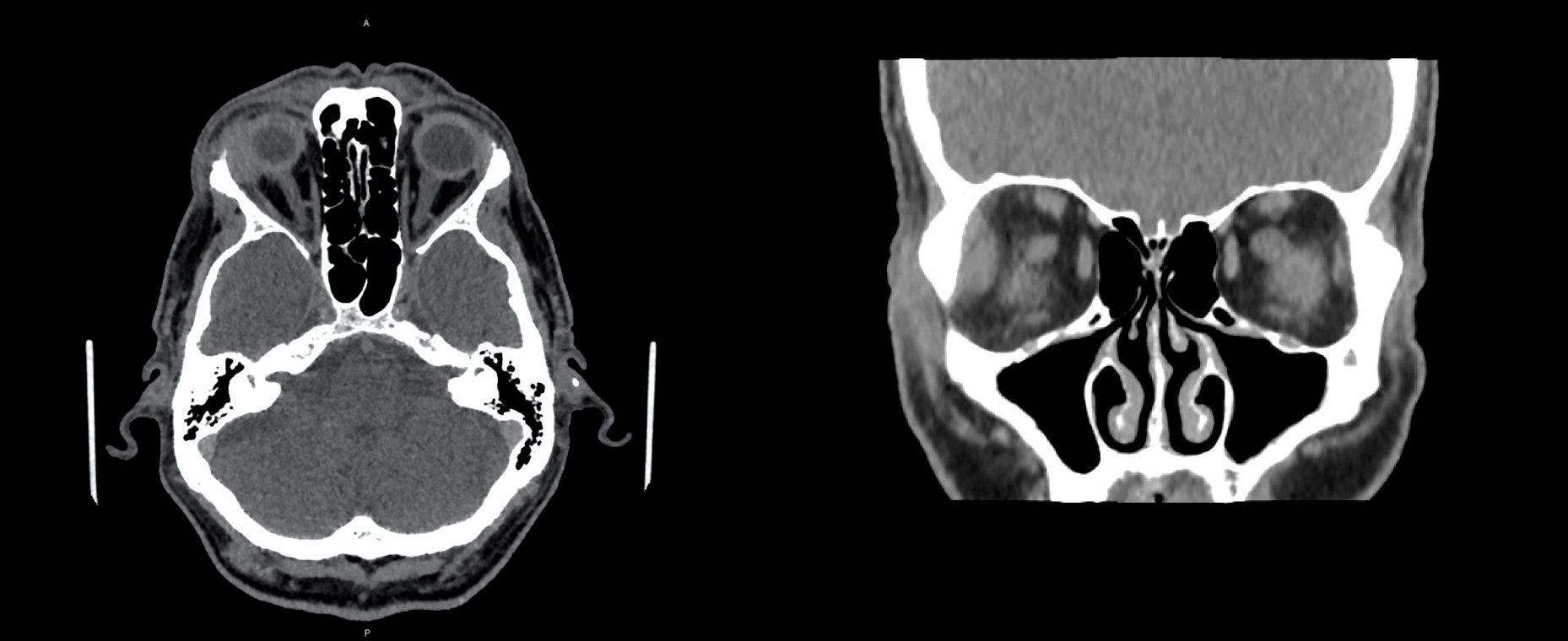 Lyme Disease Associated Orbital Myositis: A Rare Cause of Orbital ...