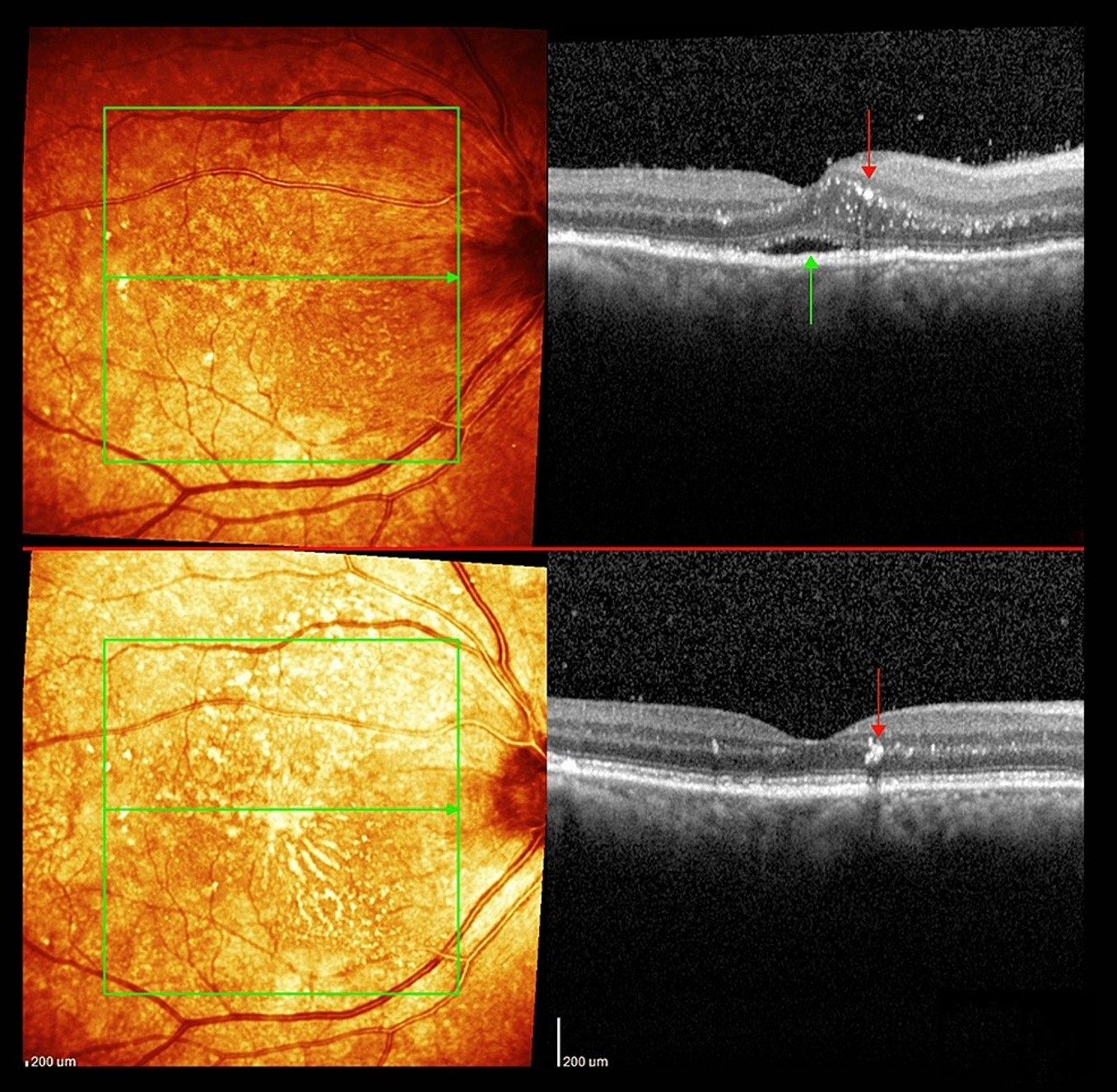 Dynamics and Treatment Response of Compartmentalised Sarcoidosis Using ...