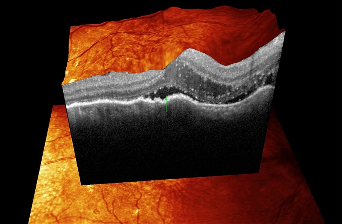 Dynamics and Treatment Response of Compartmentalised Sarcoidosis Using ...