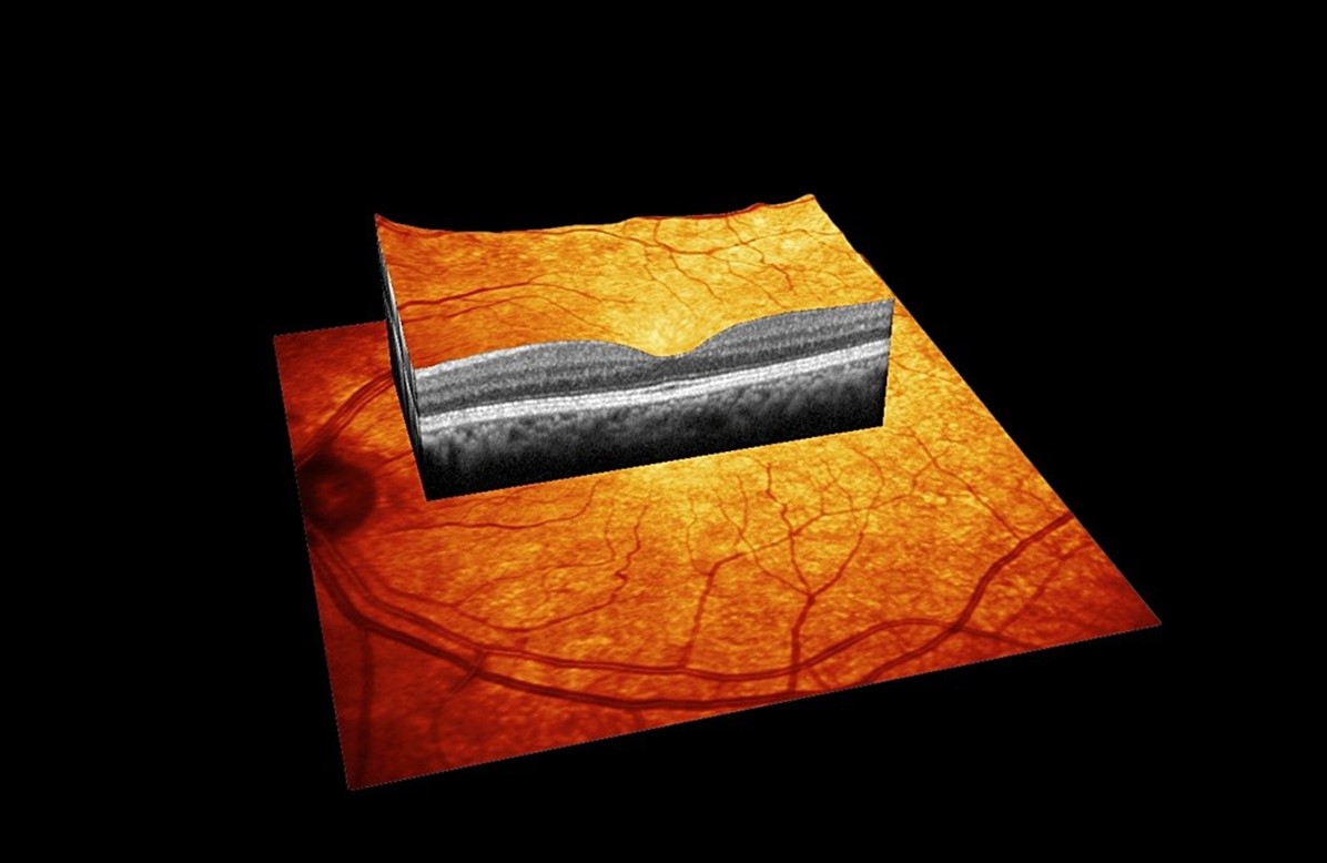 Dynamics and Treatment Response of Compartmentalised Sarcoidosis Using ...