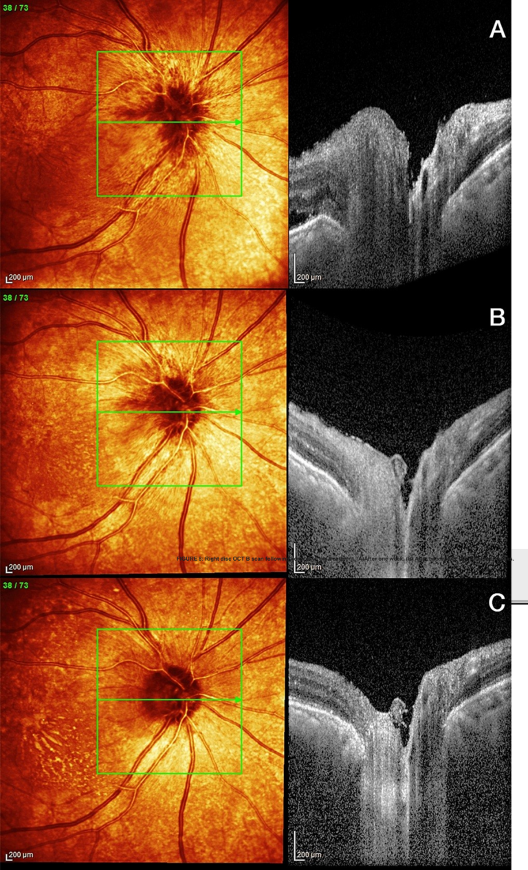 Dynamics and Treatment Response of Compartmentalised Sarcoidosis Using ...
