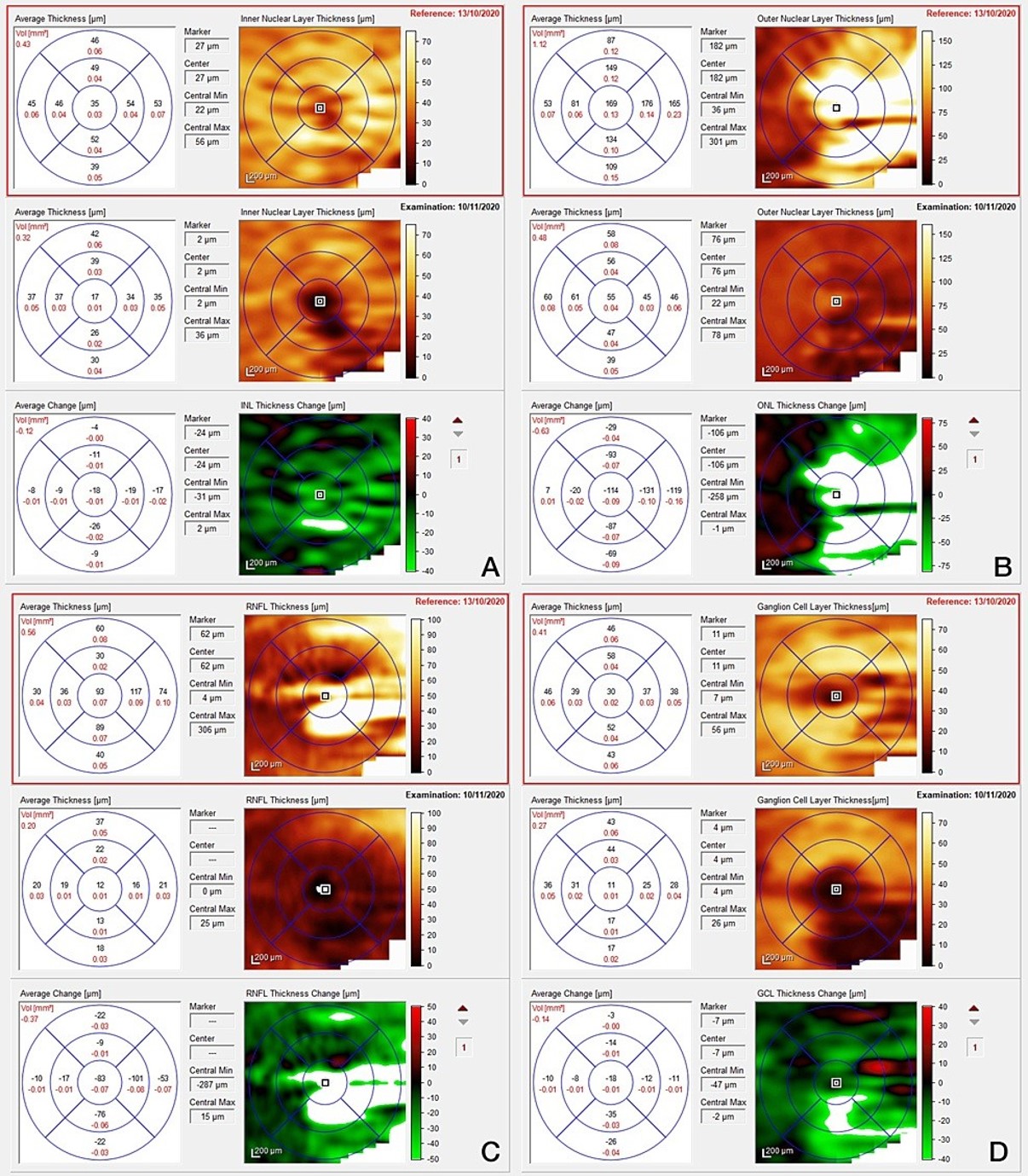 Dynamics and Treatment Response of Compartmentalised Sarcoidosis Using ...