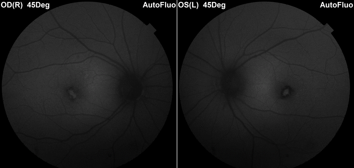 Into the Yellow: A Case of Adult-Onset Foveomacular Vitelliform ...