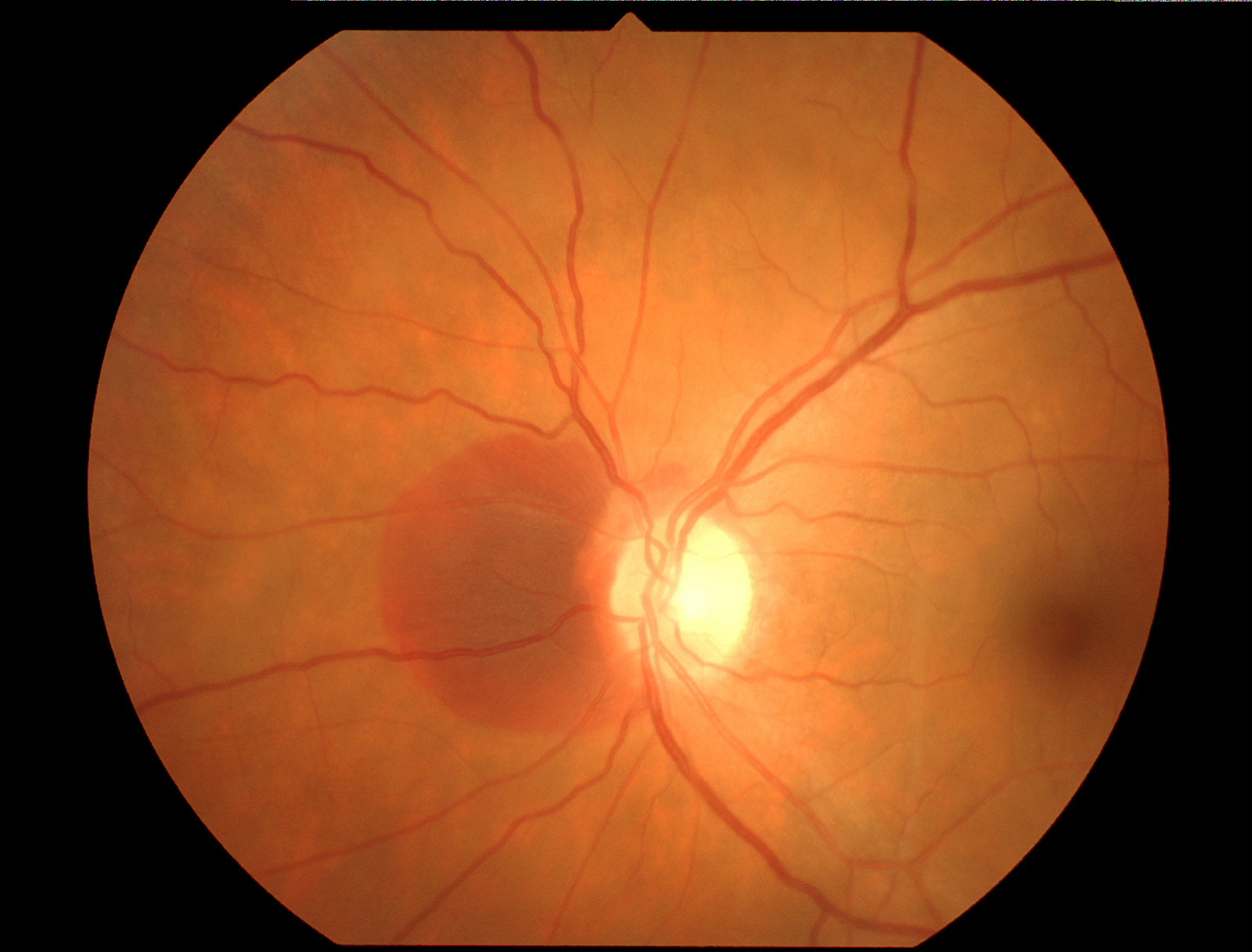 Traumatic Retinal Dialysis - Journal of the Foundations of Ophthalmology