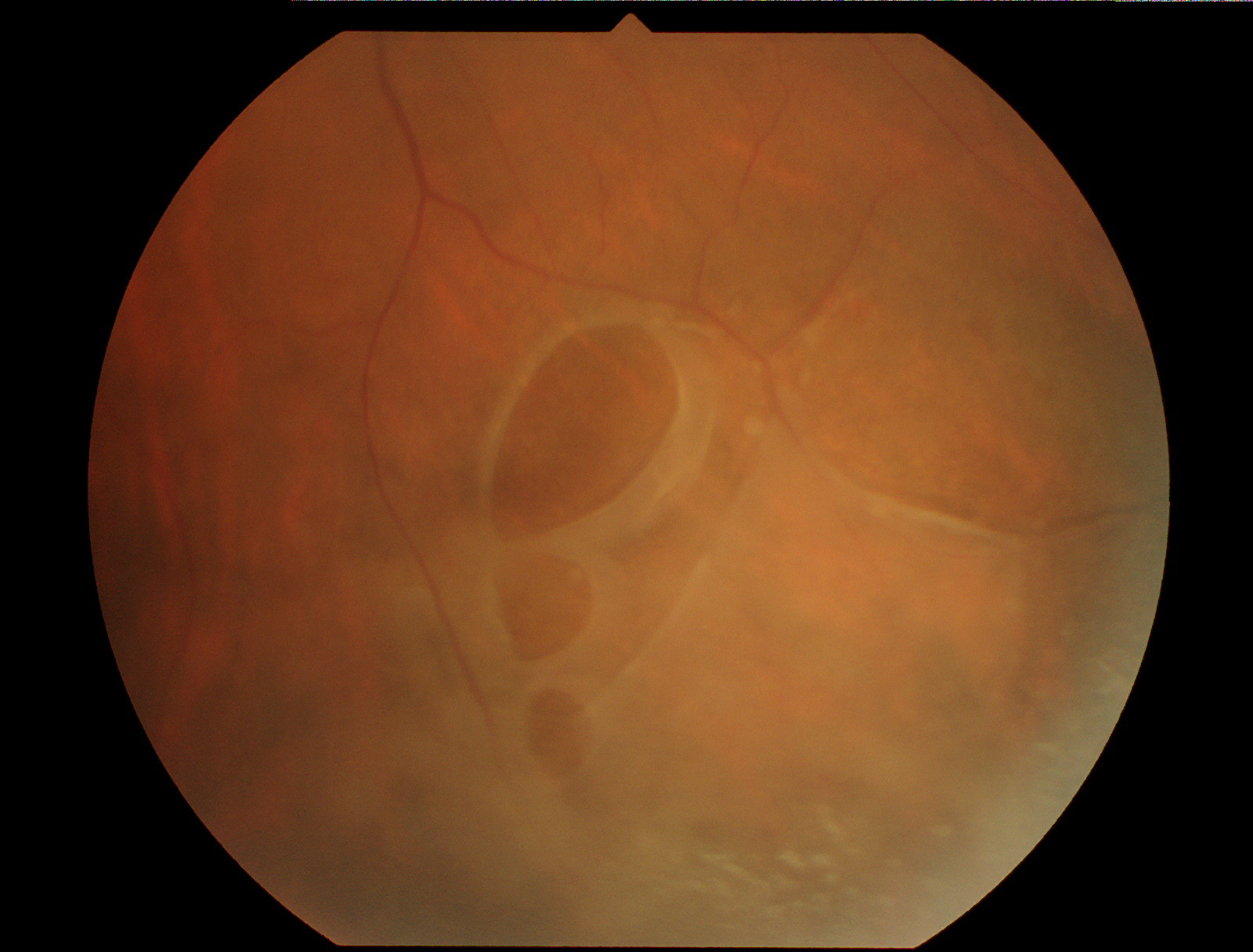 Traumatic Retinal Dialysis - Journal of the Foundations of Ophthalmology